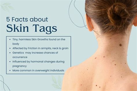 What Are Skin Tags Know The Possible Causes And Treatment Methods