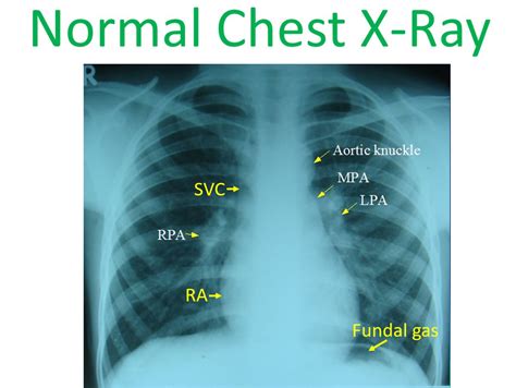 X Ray Chest Normal