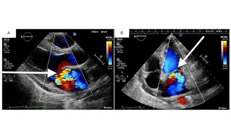 Endocarditis Vegetation On Mitral Valve