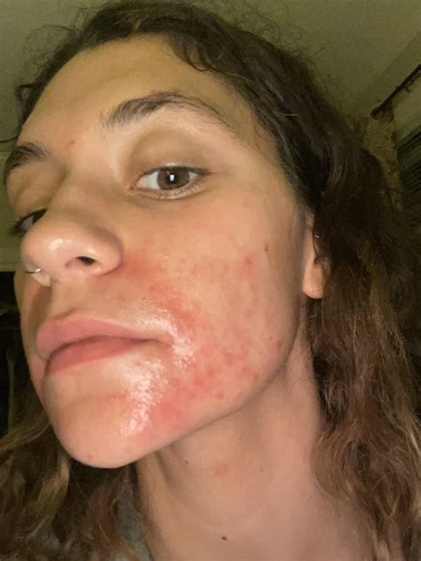 It Gets Better — Doxycycline R Perioral Dermatitis