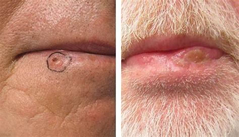 Lip Cancer Symptoms Stages And Treatment Wockr