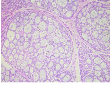Histopathology Of The Right Submandibular Gland Mass Showing Nodular