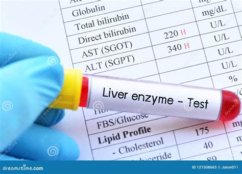 Abnormal High Liver Enzyme Test Result Stock Image Image Of Cirrhosis