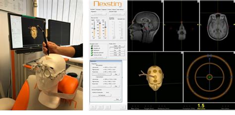 Figure 1 From Motor Areas In Patients With Motor Eloquent Brain Tumors Insights Derived From