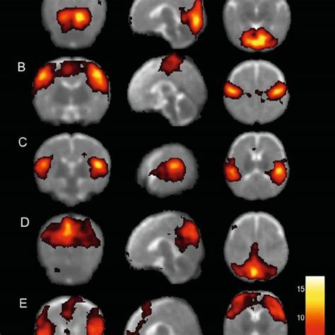 Analysis Of EEG Connectivity Using Spatial Amplitude Correlations In Download Scientific
