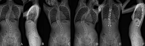 Pre And Postoperative X Rays Of A Characteristic Thoracic Curve
