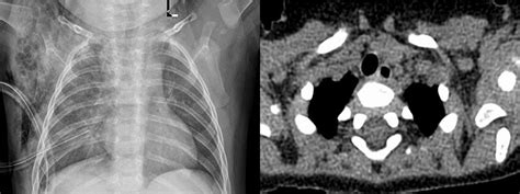 Preoperative Ct And Key Surgical Procedures Of Thoracoscopic Download Scientific Diagram