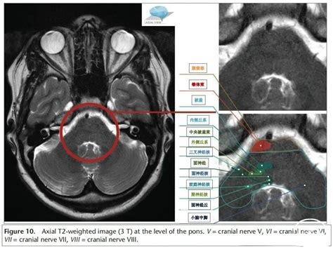 中脑、脑桥和延髓：解剖＆综合征 脑医汇