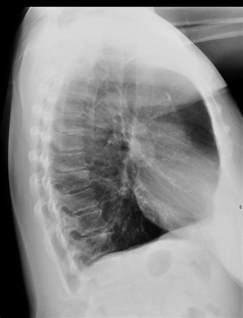 Cxr In Emphysema The Common Vein
