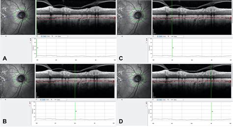 Peripapillary And Subfoveal Choroidal Thickness In Retinal Vein Occlus Opth