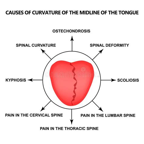 Candidiasis Of The Tongue Thrush Inflammation Of The Tongue