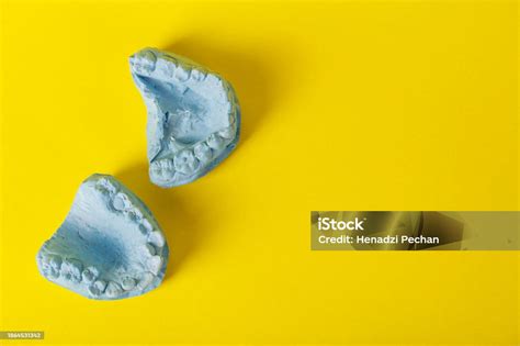 노란색 배경에 교정 치과 의사의 환자의 턱 인상의 파란색 석고 모델 교정에서 치과 보철물용 의치 및 크라운 제조 매크로 텍스트 복사 공간 치아 배열 0명에 대한 스톡 사진