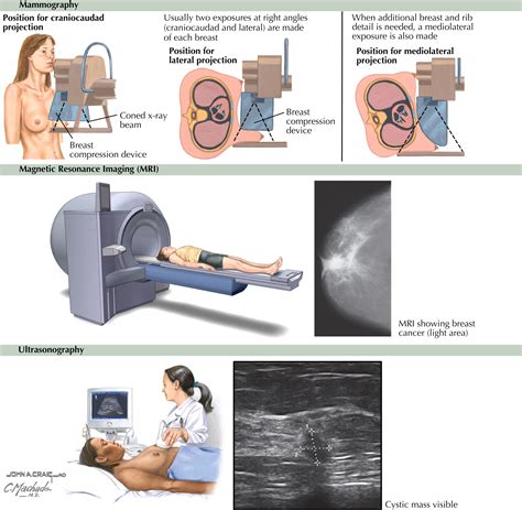 Breast Imaging Clinical Tree