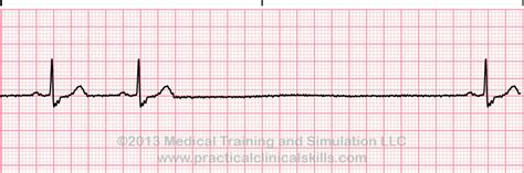 Sinus Rhythms Reference Page EKG Academy