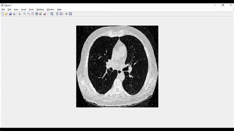 lung nodule detection deep learning matlab projects youtube