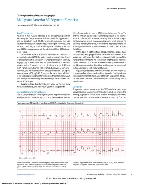 PDF Malignant Anterior ST Segment Elevation