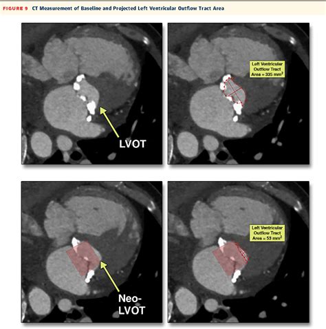 Figure 9 From Severe Mitral Annular Calcification Multimodality