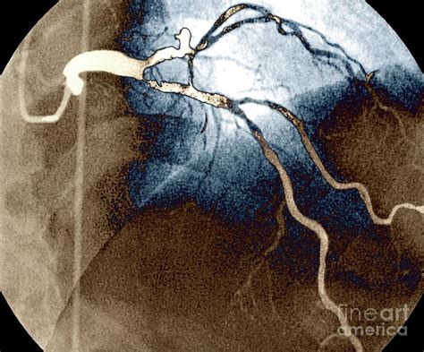 Coronary Artery Stenosis Photograph By Zephyr Science Photo Library Pixels