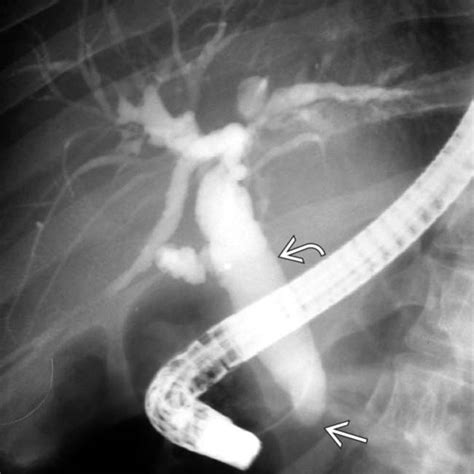 Aids Cholangiopathy Radiology Key
