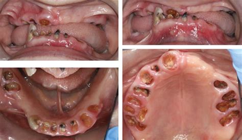 Intraoral Photographs At Time Of Consult Buccal Abscess Adjacent To
