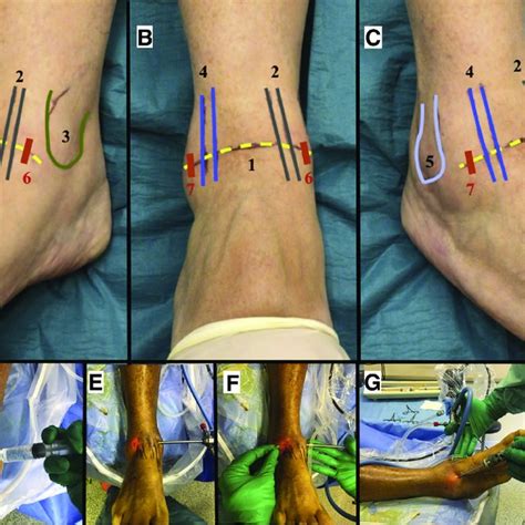 Arthroscopic Arthrodesis In A Right Ankle In A Patient With Severe Download Scientific Diagram