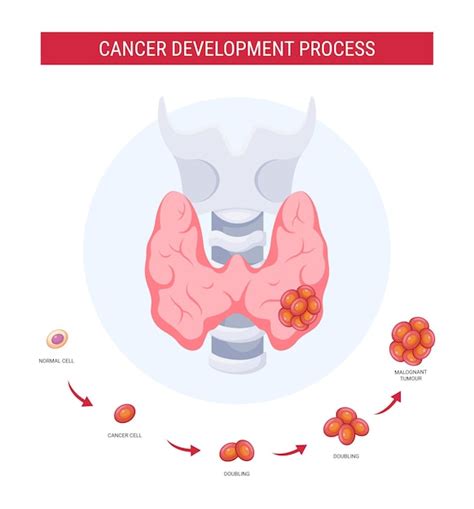 Premium Vector Thyroid Cancer Development Process