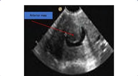 B Abnormal Sonohysterogram Showing Anterior Mass Likely A Submucous Download Scientific