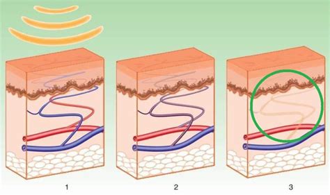 121 홍조 원인과 치료 네이버 블로그