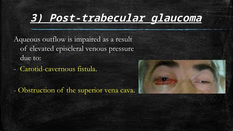 Secondary Glaucoma An Overview About Glaucoma Pptx