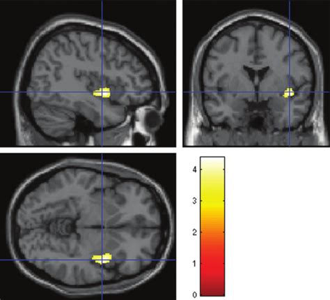 Statistical Parametric Maps Showing Regional Differences In Gm Volume Download Scientific