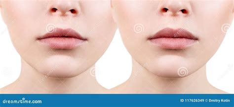 Lips Of Young Woman Before And After Augmentation Stock Image Image