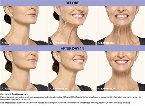 The Aging Neck Botox For The Platysmal Bands