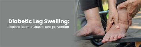 Diabetic Leg Swelling Explore Edema Causes And Prevention
