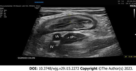 Terminal Ileum Ultrasound