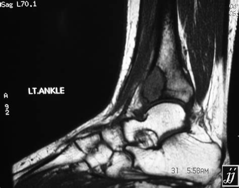 Msk Distal Tibial Cyst 6 Radioogle