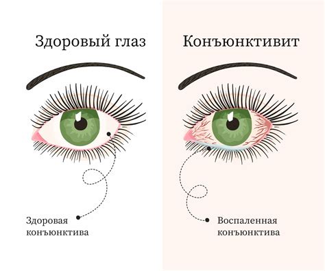 Конъюнктивит причины симптомы методы лечения и профилактика Блог мед центра Альтернатива