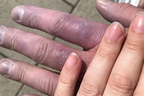 Raynauds Breastfeeding And Pregnancy Scleroderma And Raynauds Uk