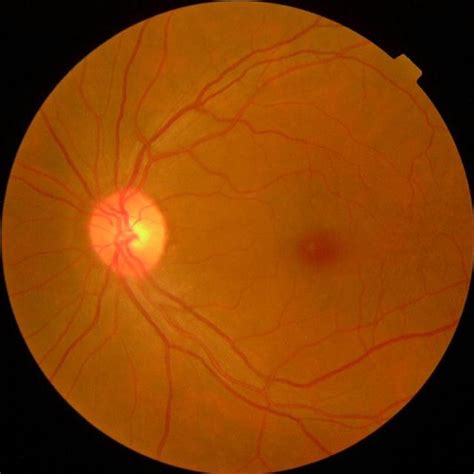 Eye Disease Detection Object Detection Model By Dina