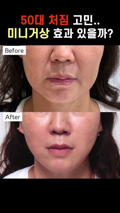 50대한테도 미니거상 효과 있을까 1달차 변화 팔자주름 볼살처짐 심부볼 얼굴처짐 미니거상 미니리프팅 모즈클리닉 모든 시술수술은 부작용이 있을 수 있습니다