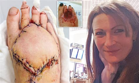 Early Pyoderma Gangrenosum