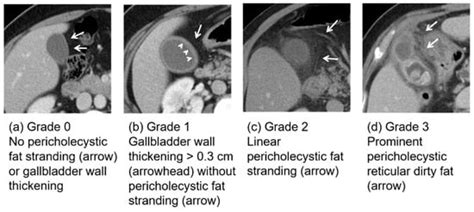 Pericholecystic Fat Stranding As A Predictive Factor Of Length Of Stays