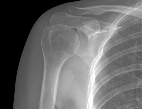 Capsulitis Adhesiva Hombro Congelado Clínica Cemtro Sg Web