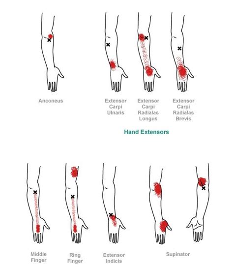 Pain Relief Trigger Point Referral Pain Patterns For The Hand Wrist