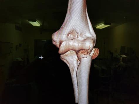 Islam Fahmy On Linkedin 29 Yrs With Com Fr Head Radius Orif Done By Mini Scews And Mini T Plate