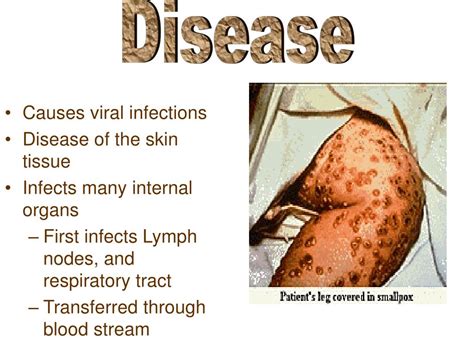 PPT Smallpox PowerPoint Presentation Free Download ID 4243965