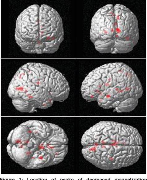 Figure 1 From A Voxel Based Comparative Analysis Using Magnetization Transfer Imaging And T1