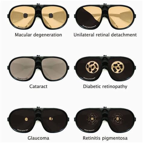 Strabismus Visual Field Loss And Visual Spatial Neglect Strabismus World