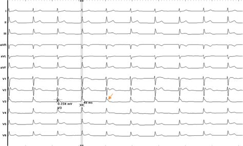 Ecg Of Patient Nr 2 Presenting With Early Repolarization Syndrome J