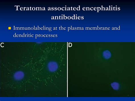 Ppt Anti Nmdar Encephalitis The Mcgill Experience Powerpoint Presentation Id 6643154