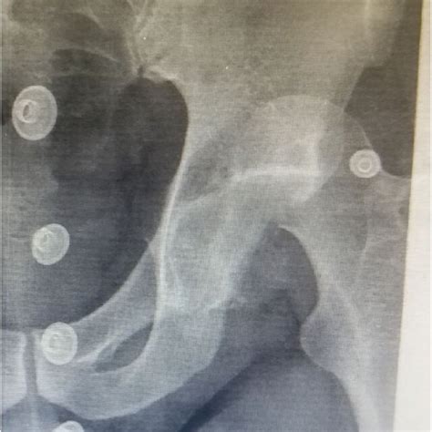 Preoperative Ct Scan Of The Pelvis Shows The Dislocation With The